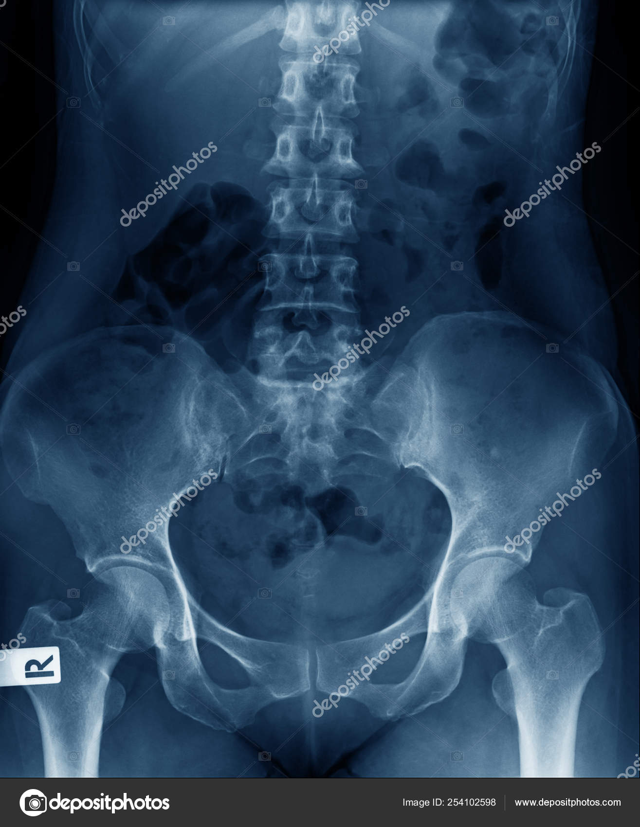 Radiografia Do Osso Pelvico Osso Anca Pélvico Ilustração Stock.