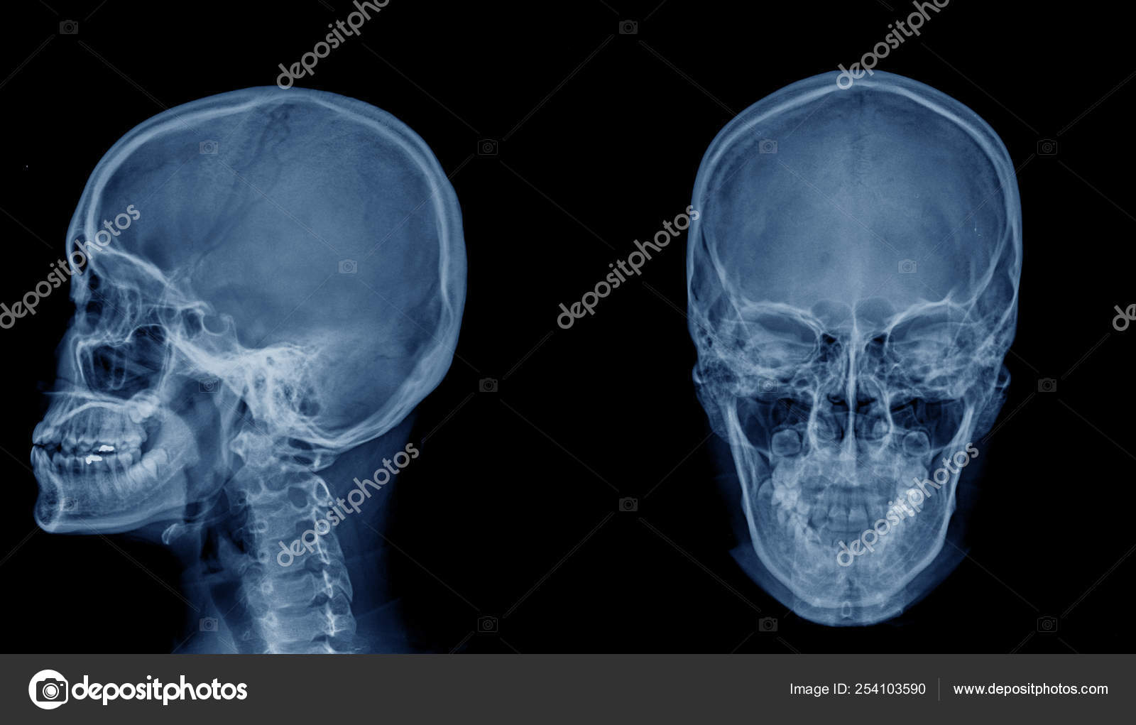 Imagen de rayos X del cráneo AP — Foto de stock © Tridsanu #254103590