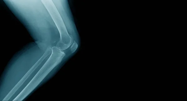 Lateral View Human Knee Joint Banner Design — Foto Stok © Tridsanu ...