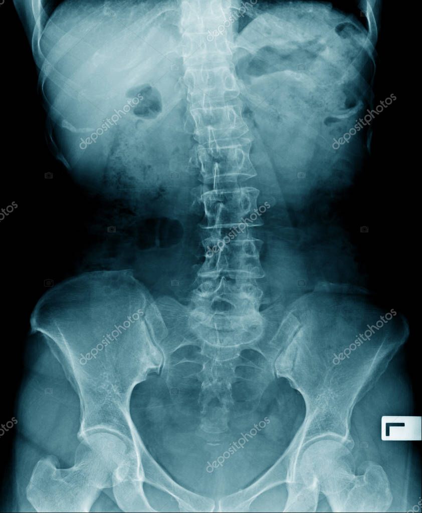 Imagen de rayos X de la columna vertebral humana en tono azul 2024