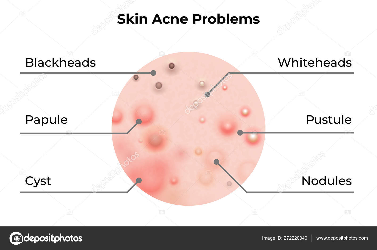 Diagrama De Acne