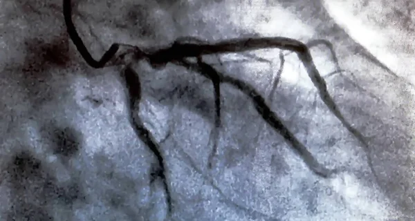 Angiogram Stock Photos, Royalty Free Angiogram Images | Depositphotos