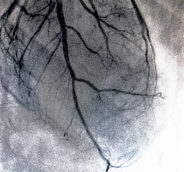Angiogram Stock Photos, Royalty Free Angiogram Images | Depositphotos