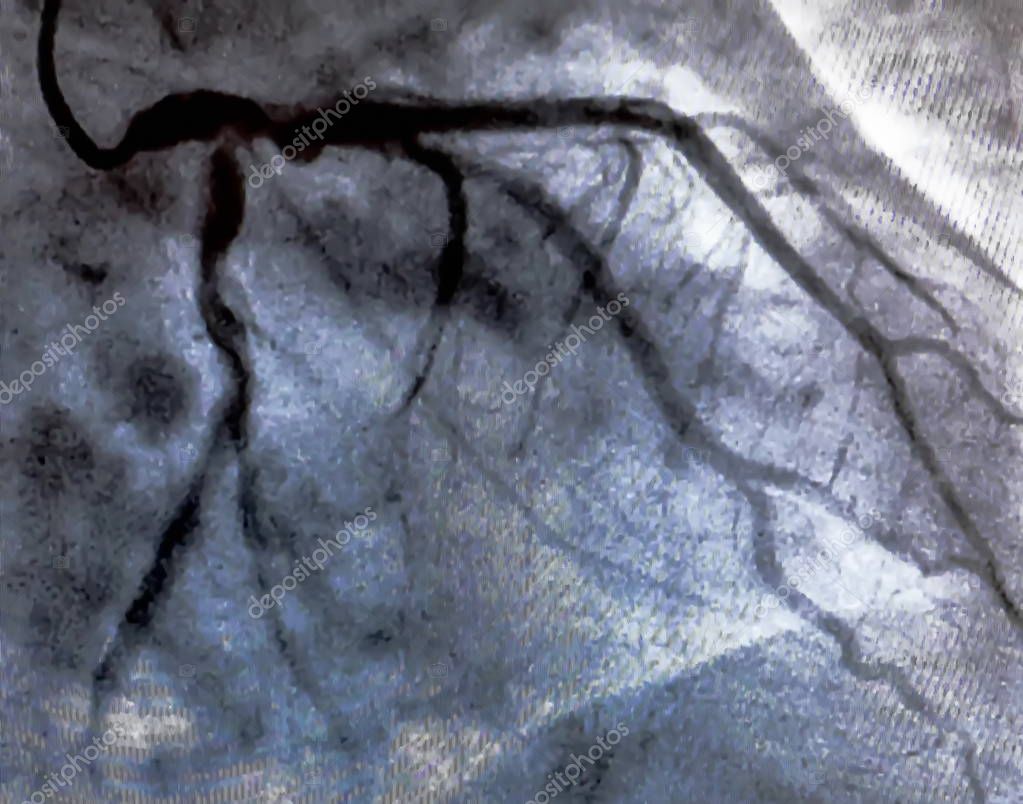 Cateterismo. La ventriculografía cardiaca es una prueba de imagen ...