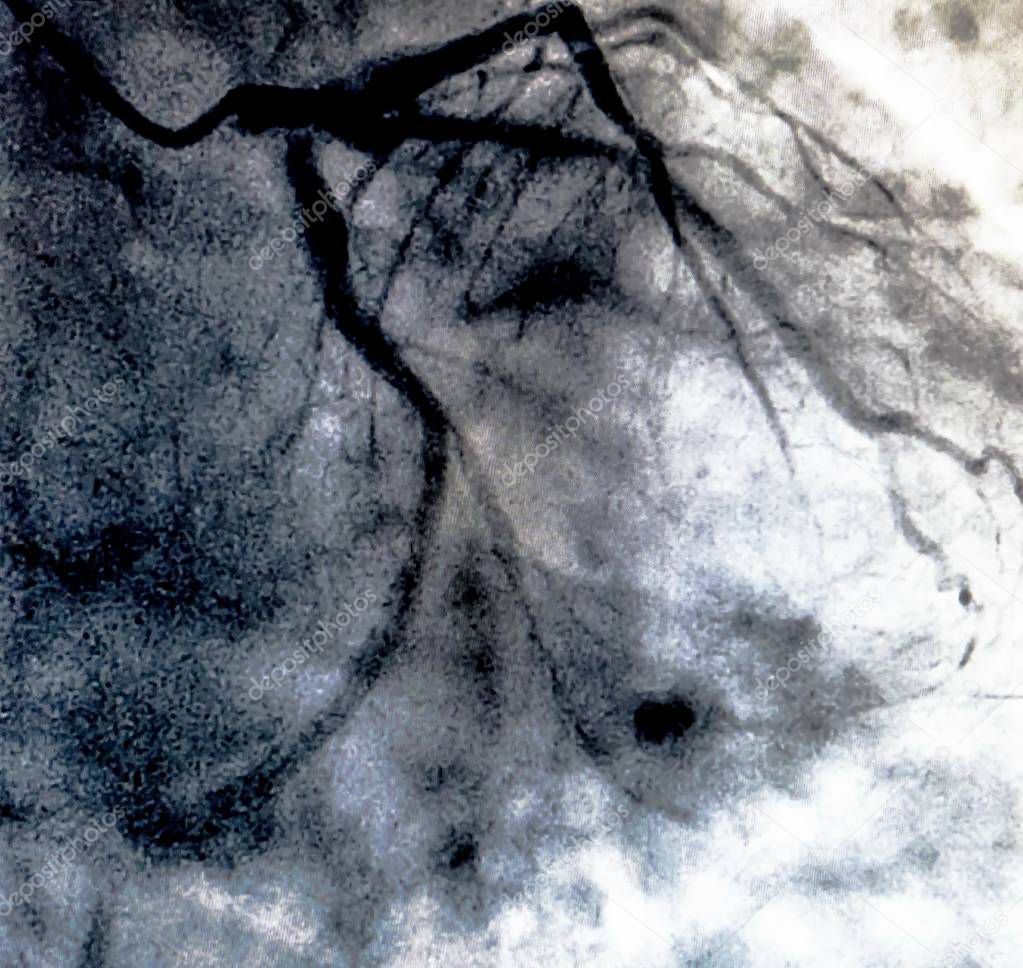 Cateterismo. La ventriculografía cardiaca es una prueba de imagen ...