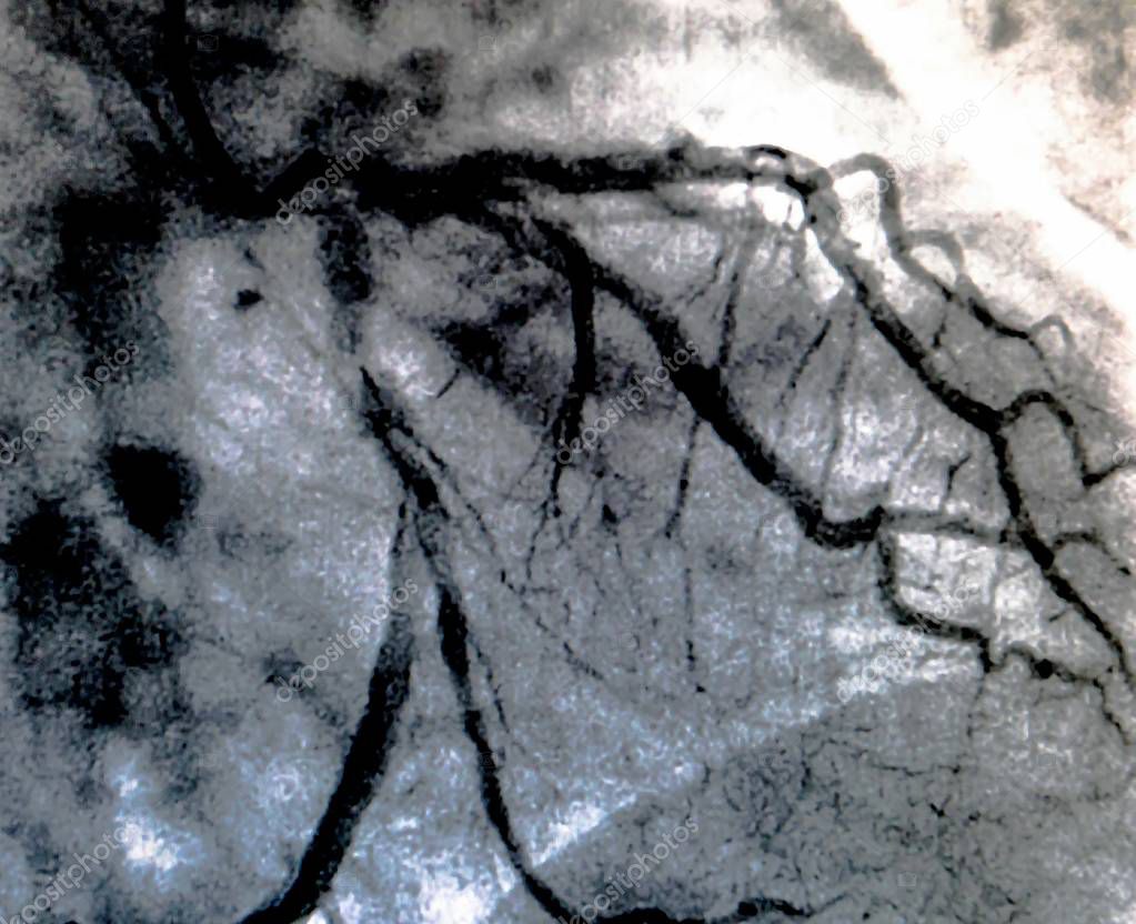 Cateterismo. La ventriculografía cardiaca es una prueba de imagen ...