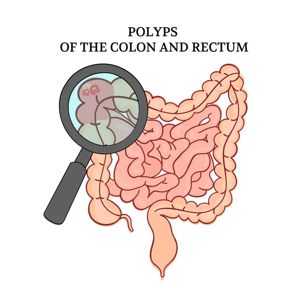 56 Colon polyps Vector Images | Depositphotos