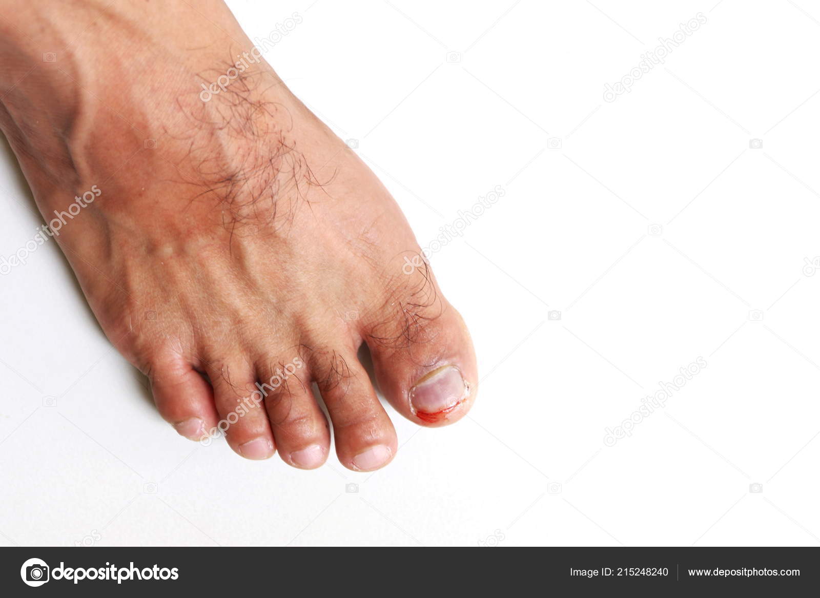 Figure Out Nail Accident Nail Trauma Bleeding Toe Nails Foot Stock ...