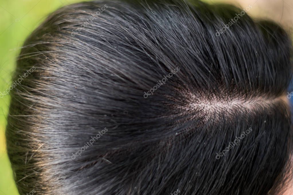 mujeres cabeza con caspa causada por el problema de la suciedad. O ...