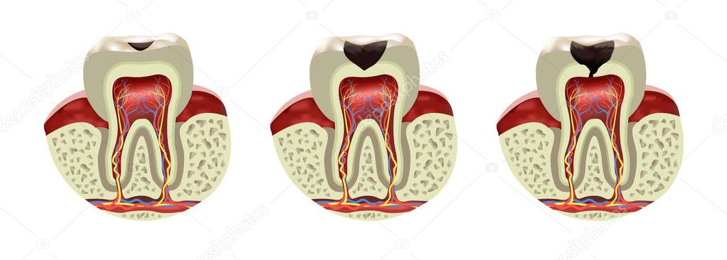 Internal structure of tooth Stock Vector Image by ©Bastetamon #9903339