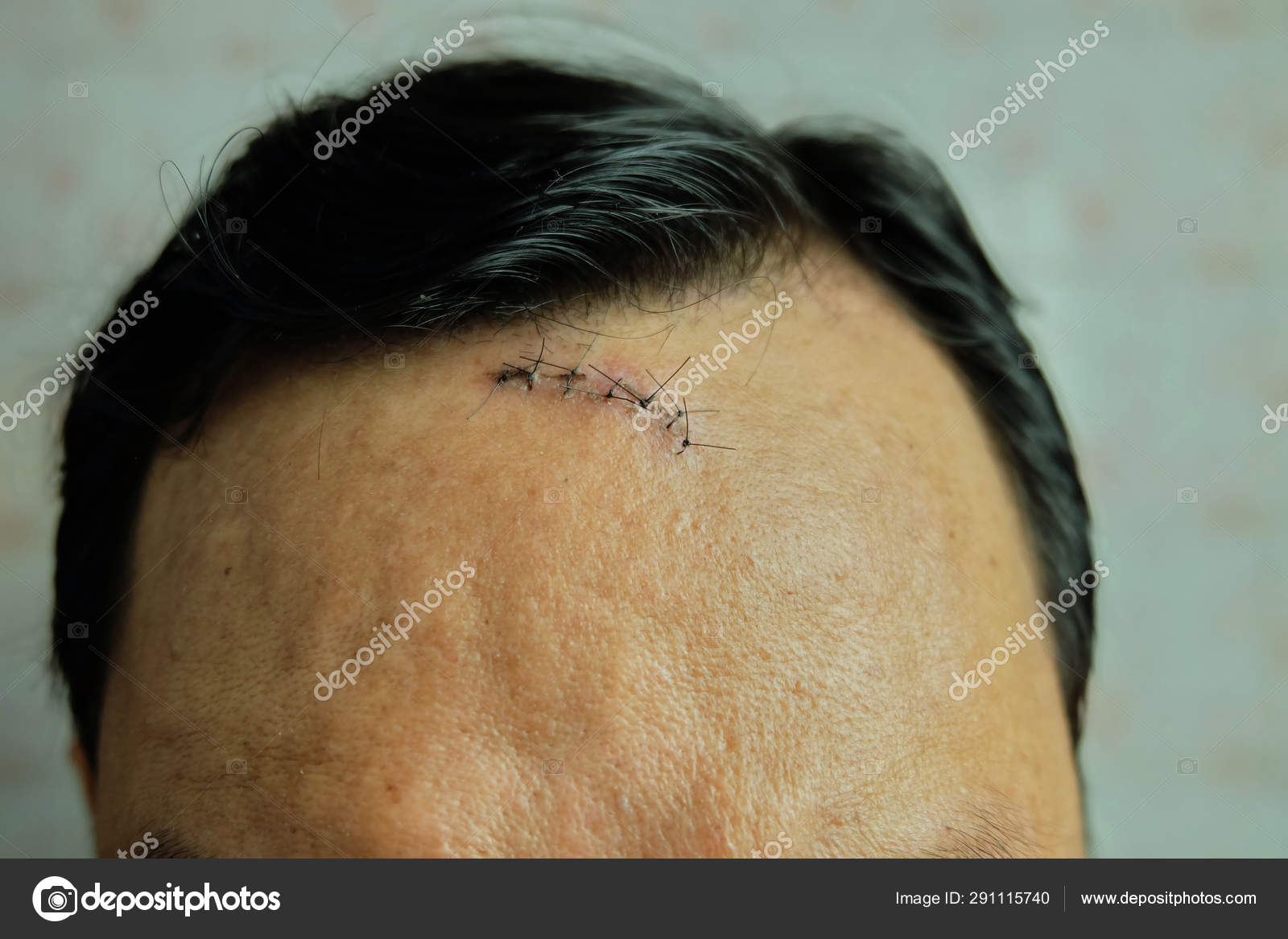 Suture Sewn Seven Stitches Head Accident Head Injury Selective Focus ...