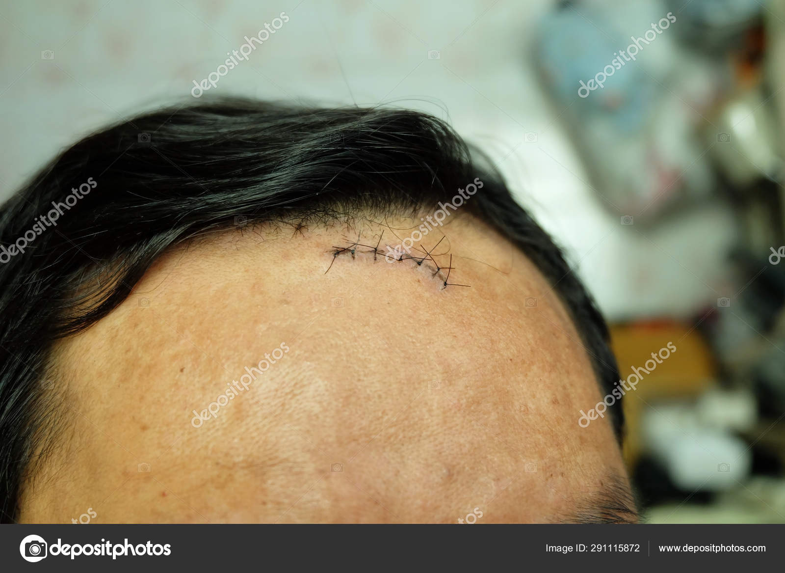 Suture Sewn Seven Stitches Head Accident Head Injury Selective Focus ...