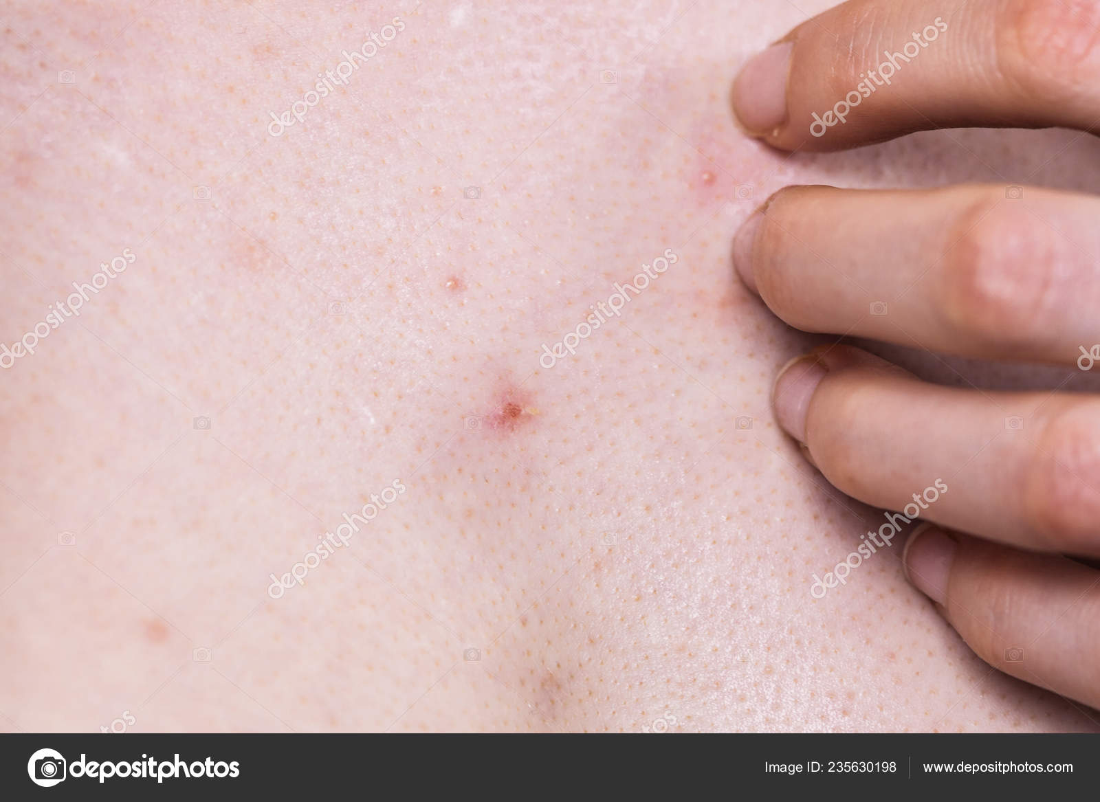 Woman Having Pimples Red Spots Dermatoses Skin Condition Problems ...