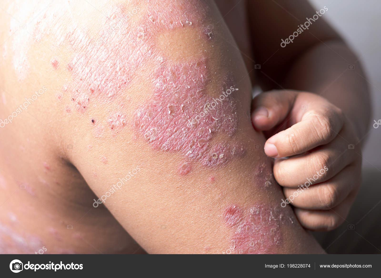 Skin Diseases On Arms