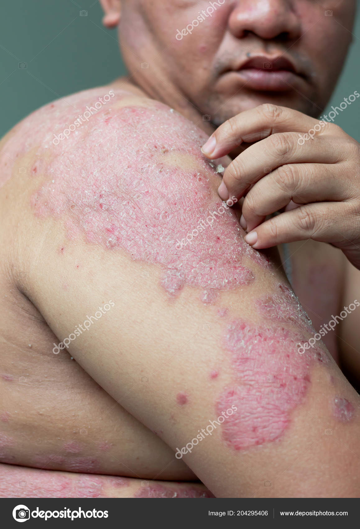 Skin Diseases On Arms