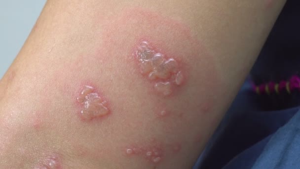 Shingles, Zoster or Herpes Zoster symptoms on arm Stock Photo by ©toa55 ...