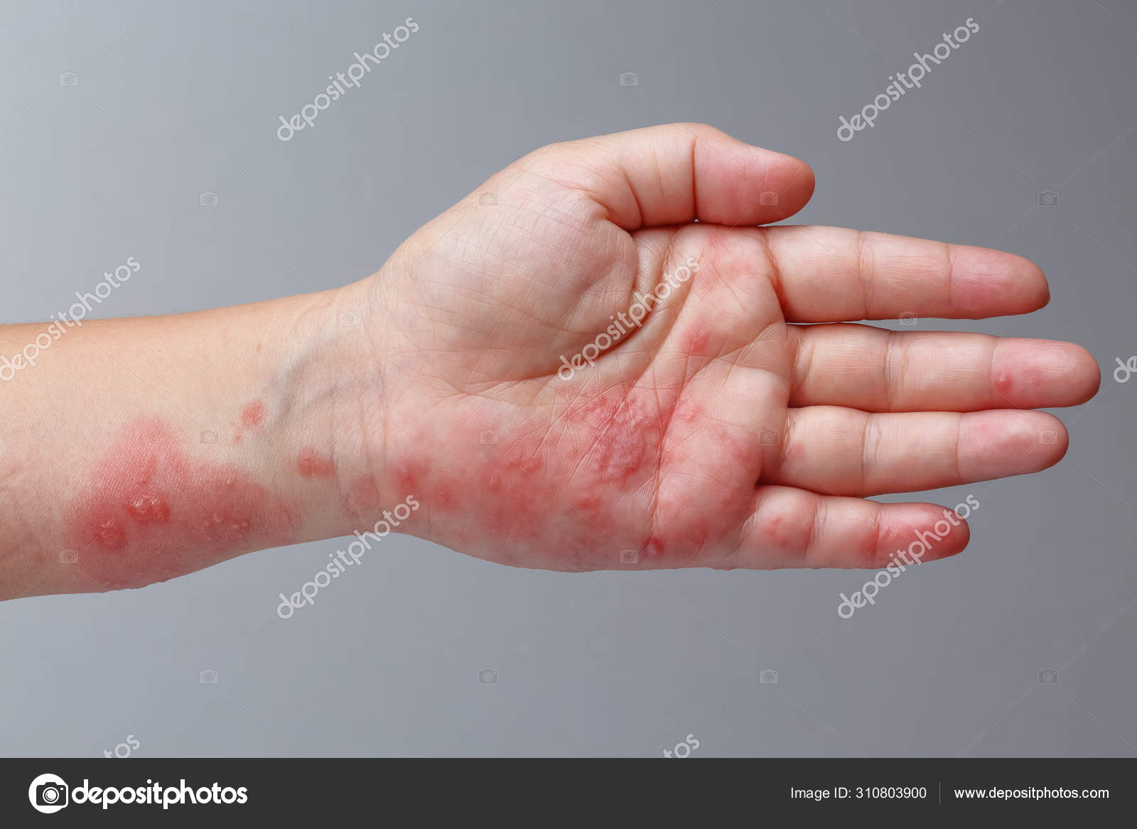 Herpes Disease On Hand