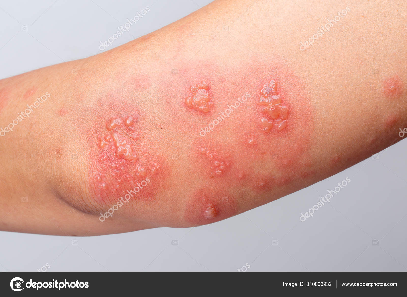 Shingles, Zoster or Herpes Zoster symptoms on arm Stock Photo by ©toa55 ...