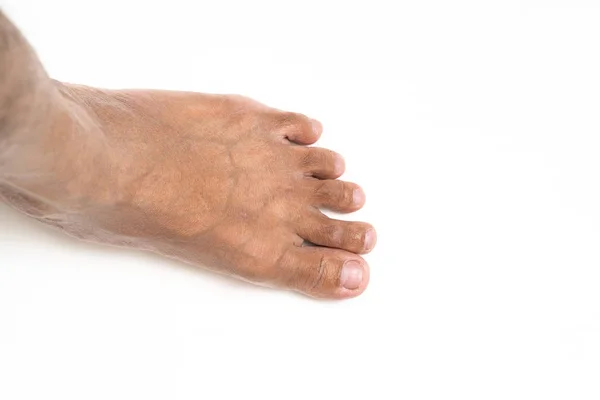 Foot rash Stock Photos, Royalty Free Foot rash Images | Depositphotos