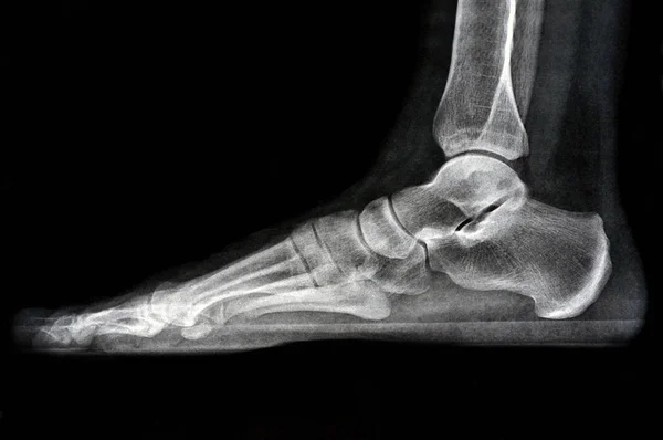 Voet x ray Stock Photos, Royalty Free Voet x ray Images | Depositphotos