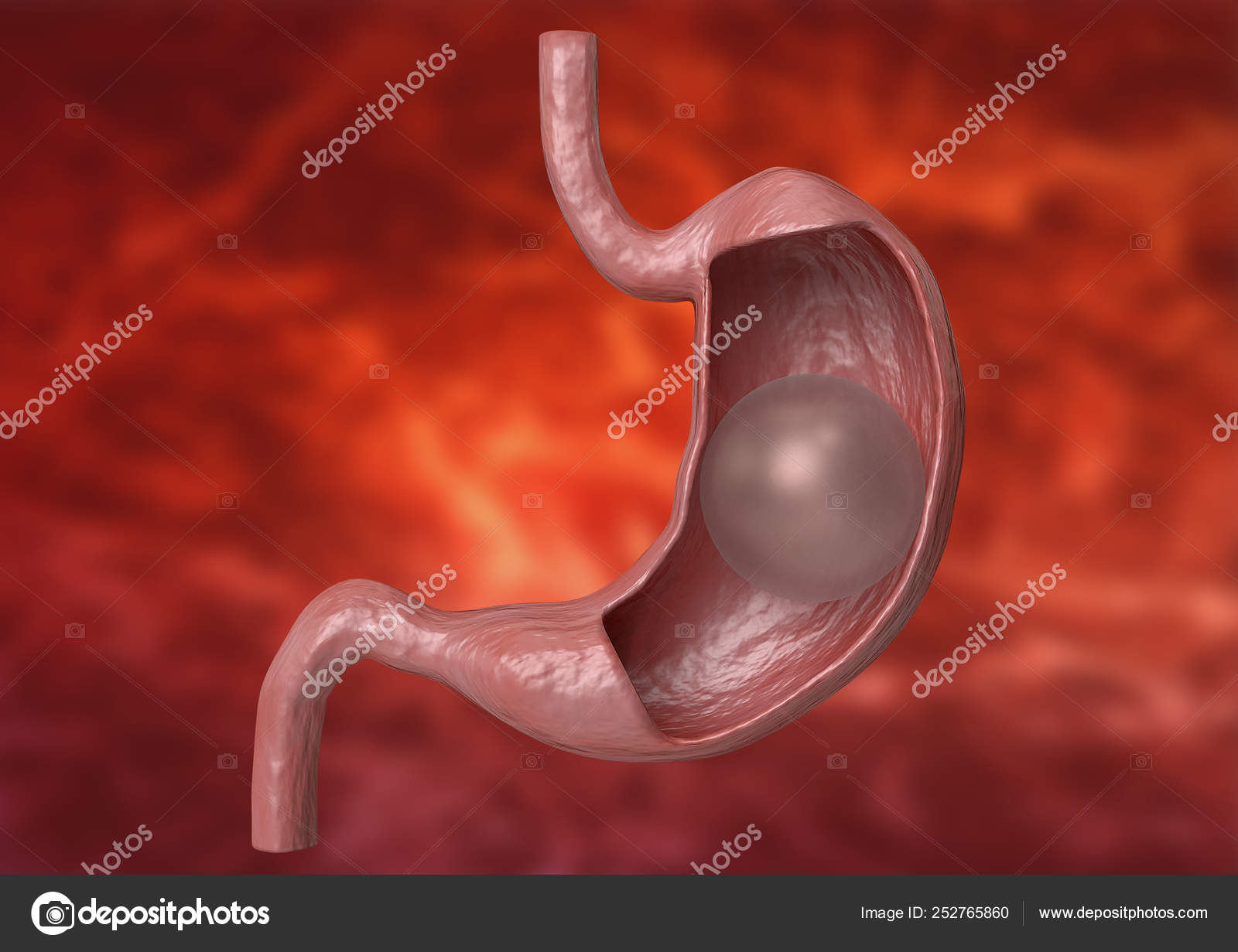Balloon gastric. inflatable device that is placed in the stomach to ...