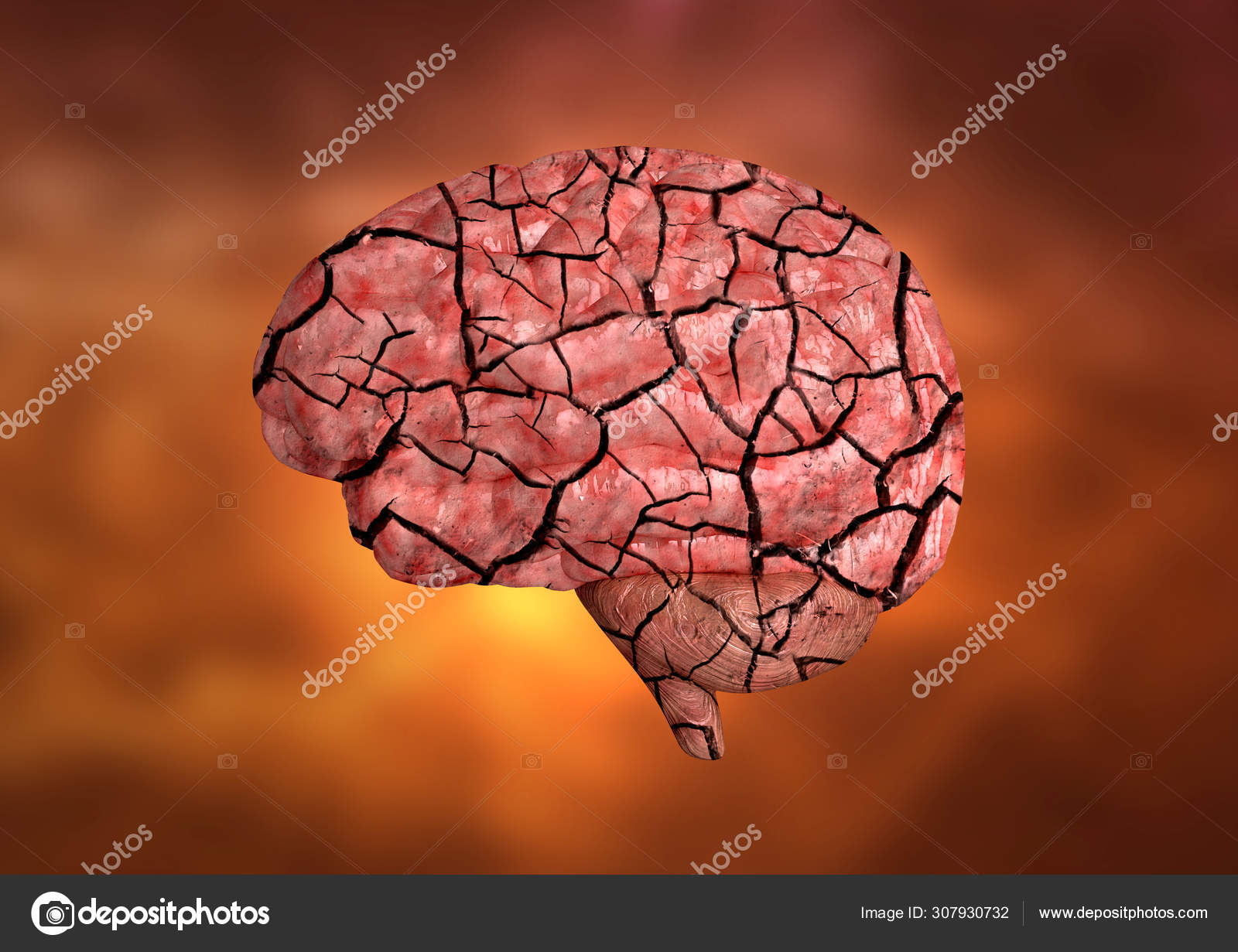 Multiple sclerosis adalah penyakit autoimun yang mempengaruhi otak ...