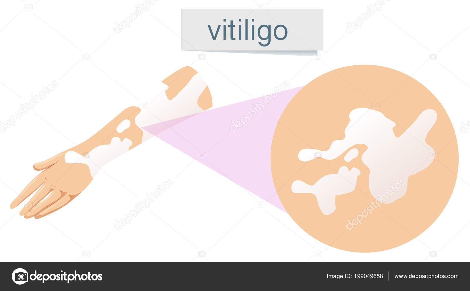 Vector Vitiligo Skin Illustration Stock Vector Image by ©blueringmedia ...