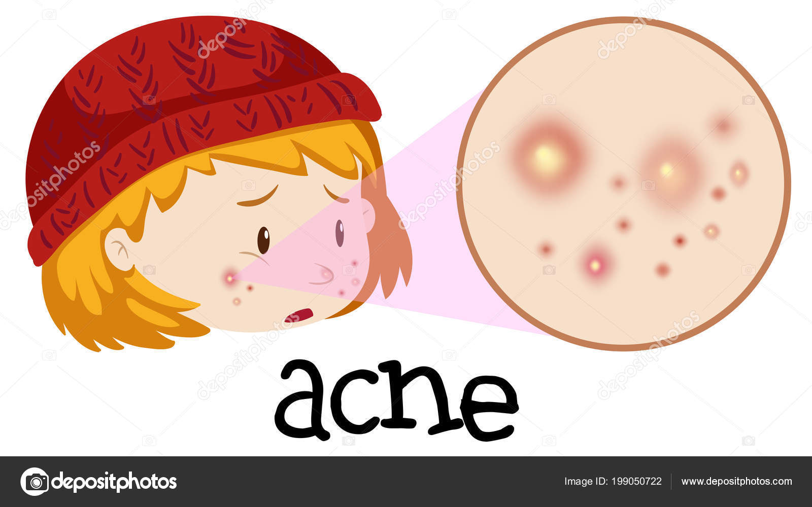 Teenage Having Acne Face Illustration Stock Vector Image by ...