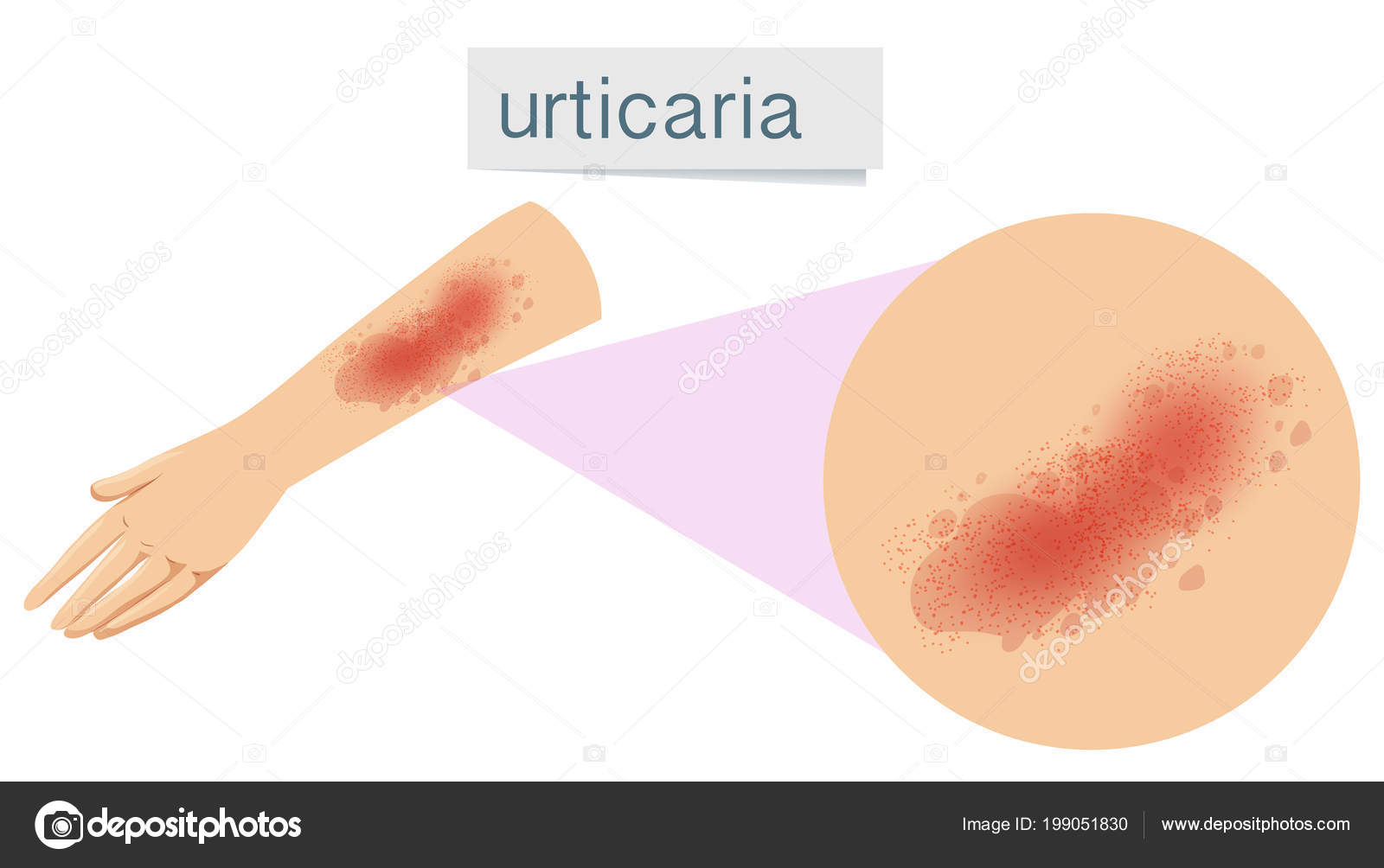 Human Skin Problem Urticaria Illustration Stock Vector Image by ... Human Skin Problem Urticaria Illustration Stock Vector Image by ...