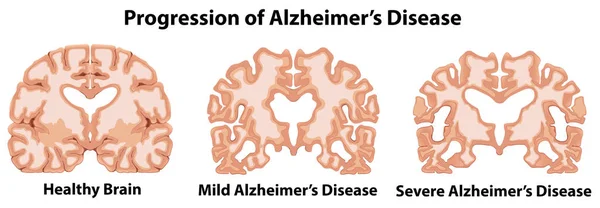 100,000 Alzheimerova choroba Vector Images | Depositphotos