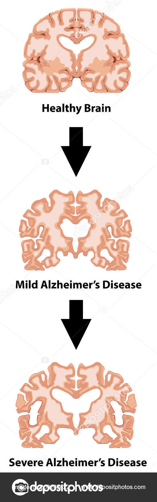 Stages Alzheimers Disease Illustration Stock Vector Image by ...