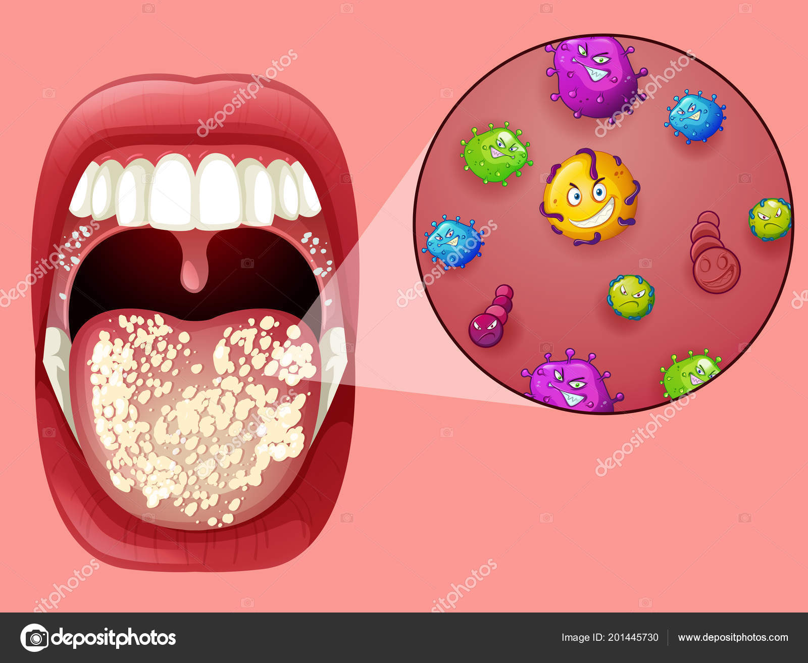 Boca Humana Con Ilustración Candidiasis Oral Vector de stock por ...