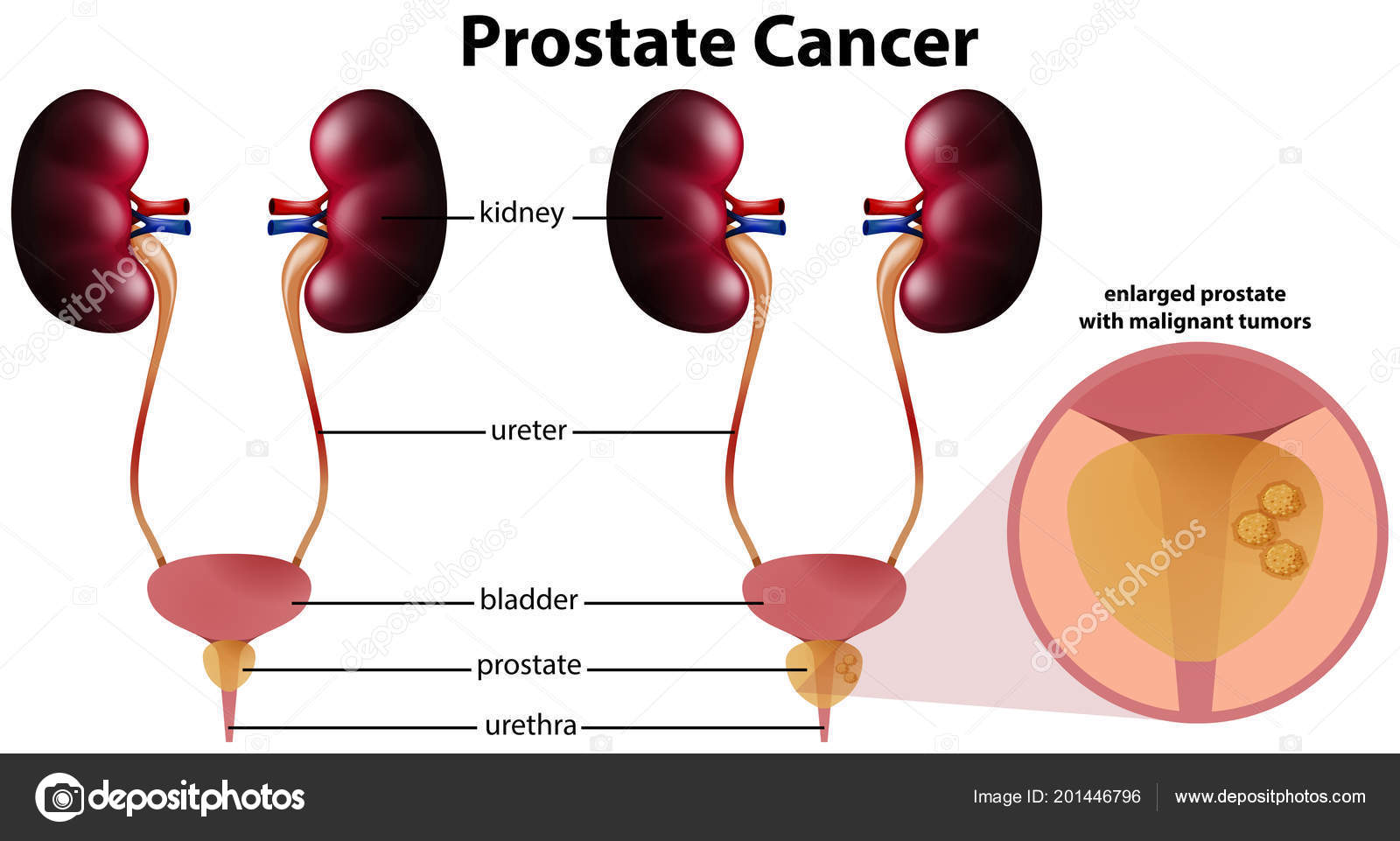 Prostate Cancer White Background Illustration Stock Vector Image by ...
