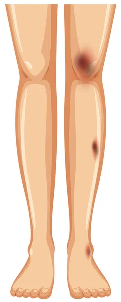 ᐈ Cartoon bruises stock vectors, Royalty Free bruises illustrations ...