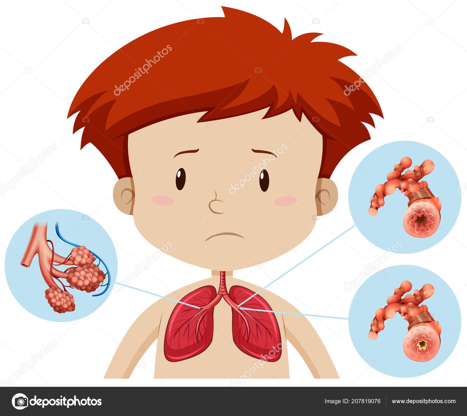 Boy Bronchitis Illustration Stock Vector by ©blueringmedia 207819076