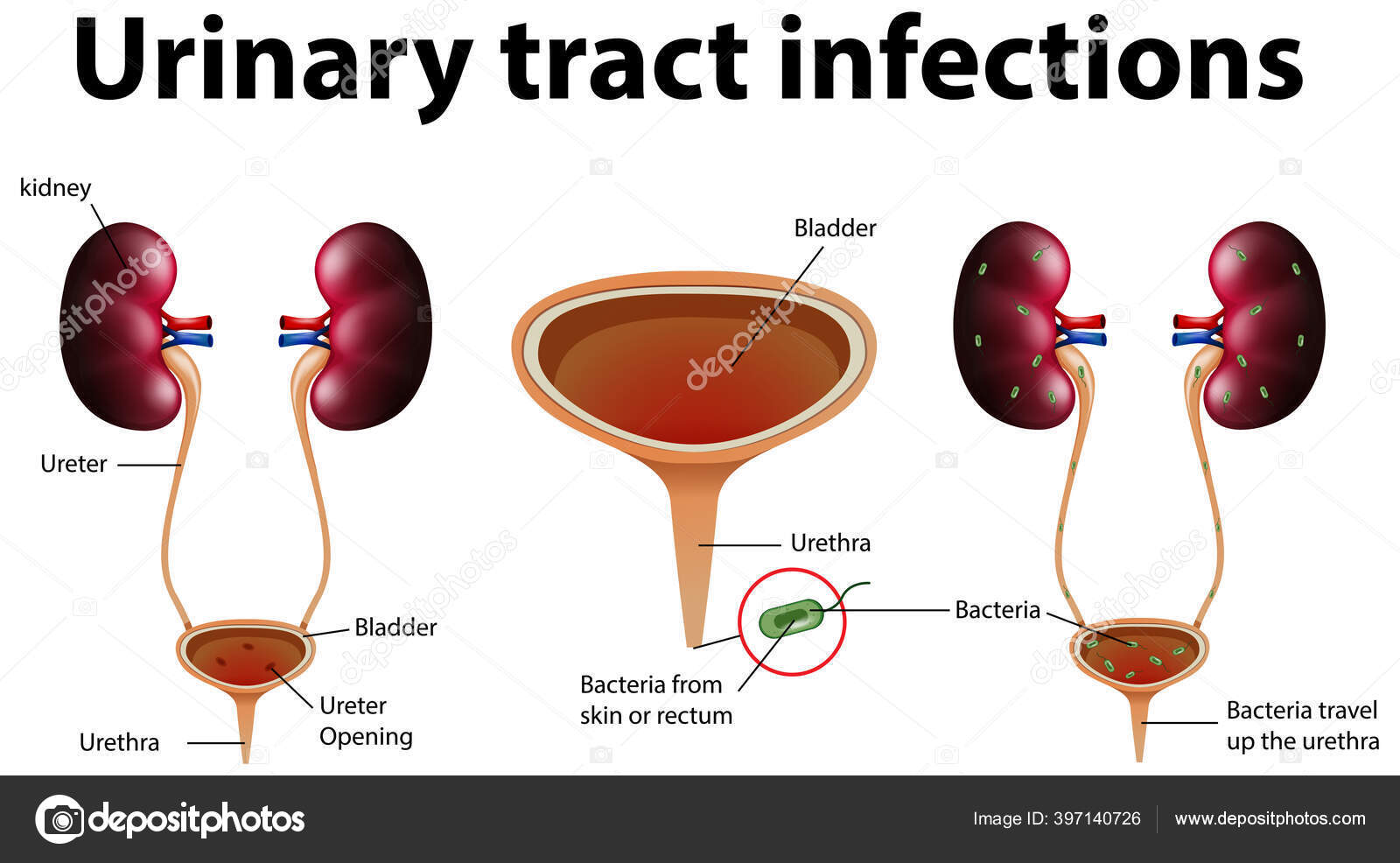 Informative Illustration Urinary Tract Infections Illustration Stock ...