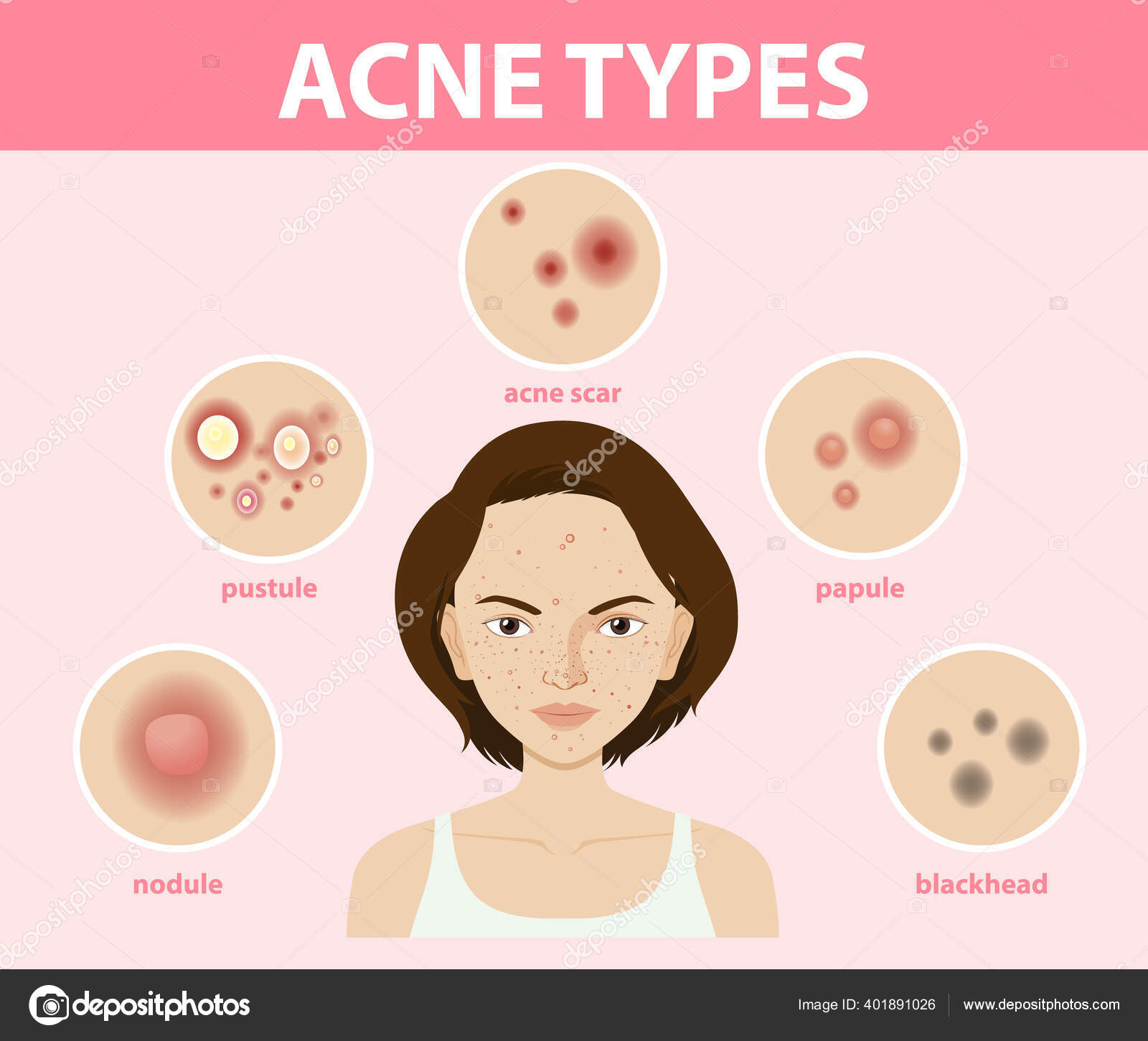 Types Acne Skin Pimples Illustration Stock Vector Image by ...