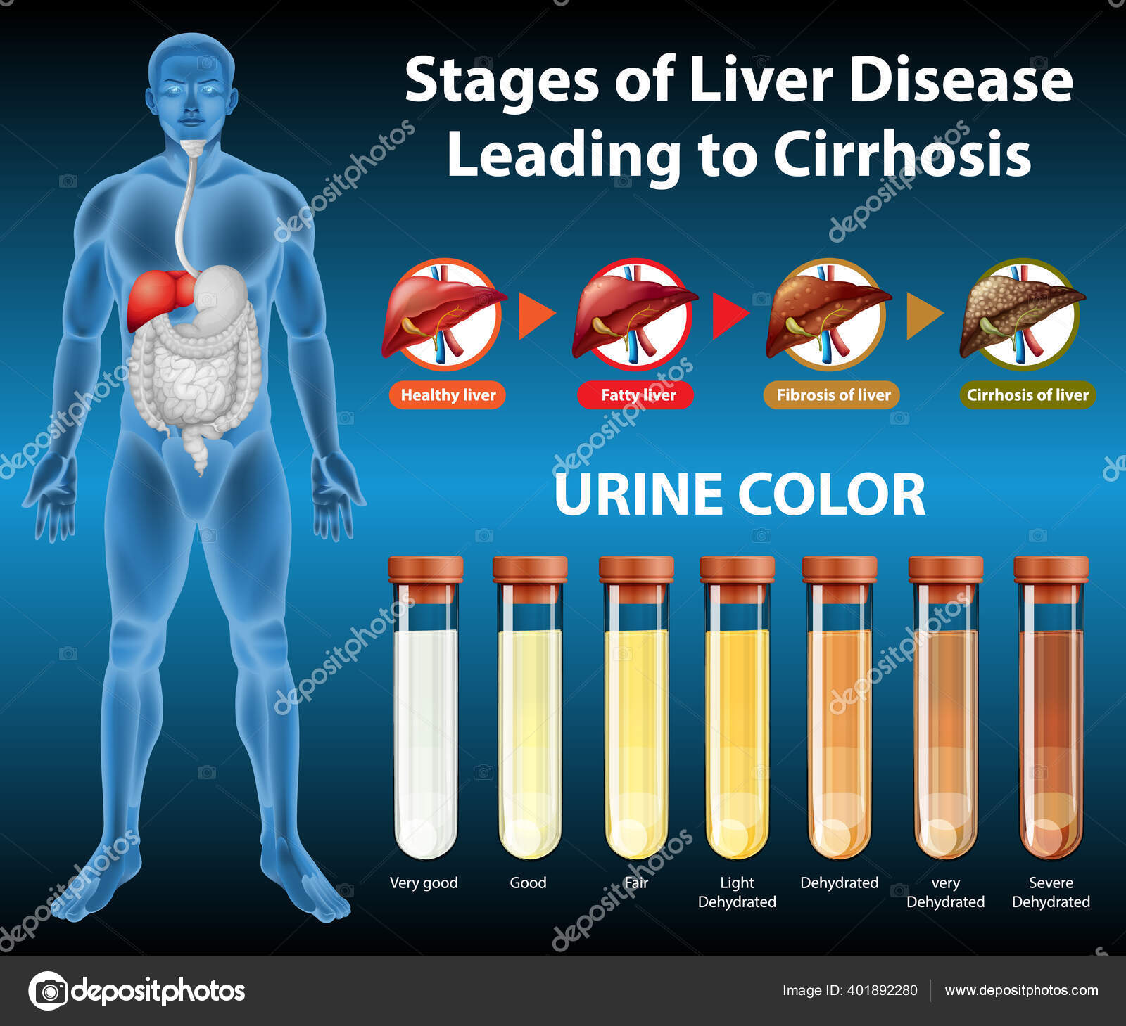 Stages Liver Disease Illustration Stock Vector by ©blueringmedia 401892280