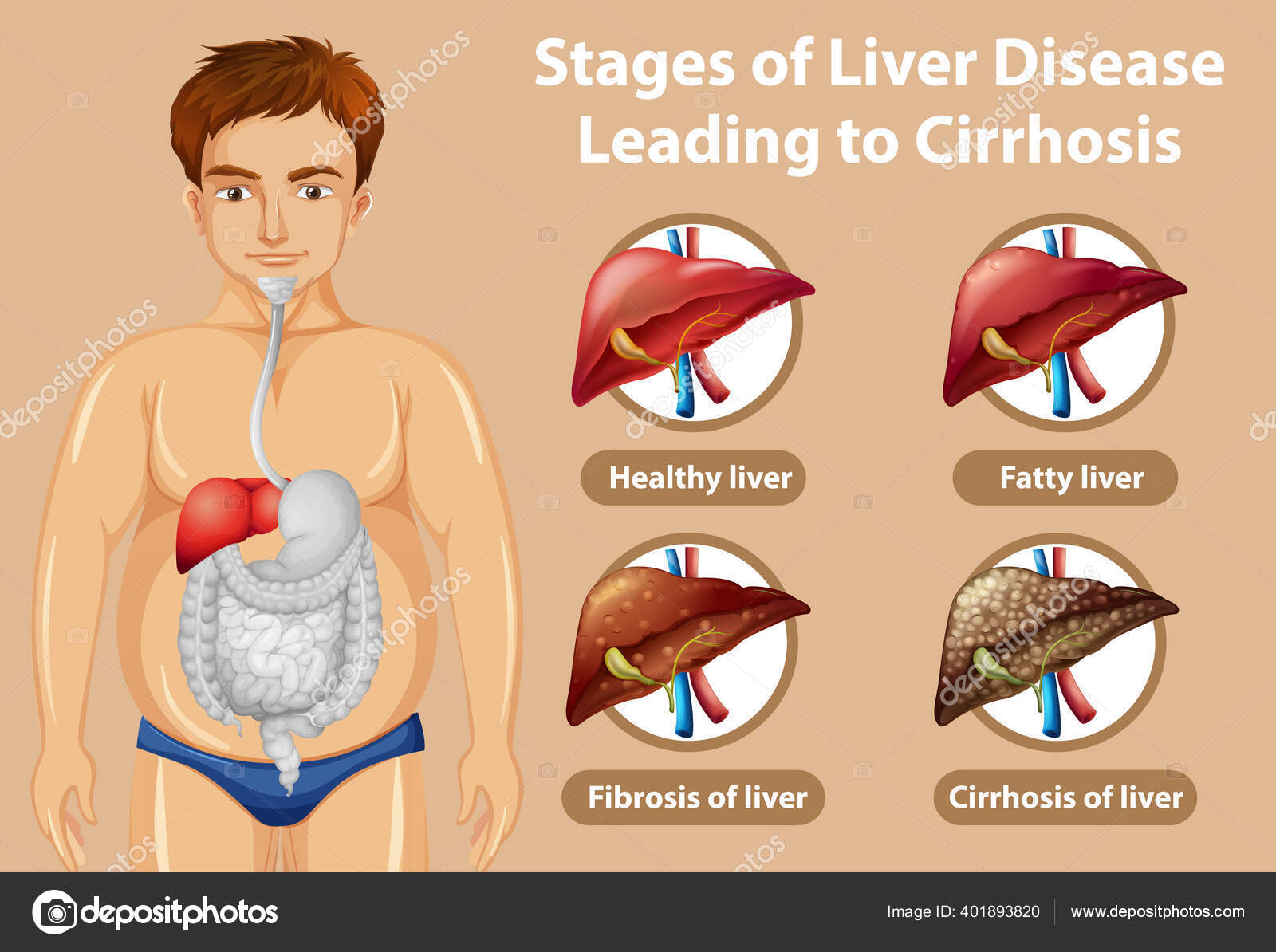 Estadios Enfermedad Hepática Que Conducen Cirrosis Ilustración Vector ...