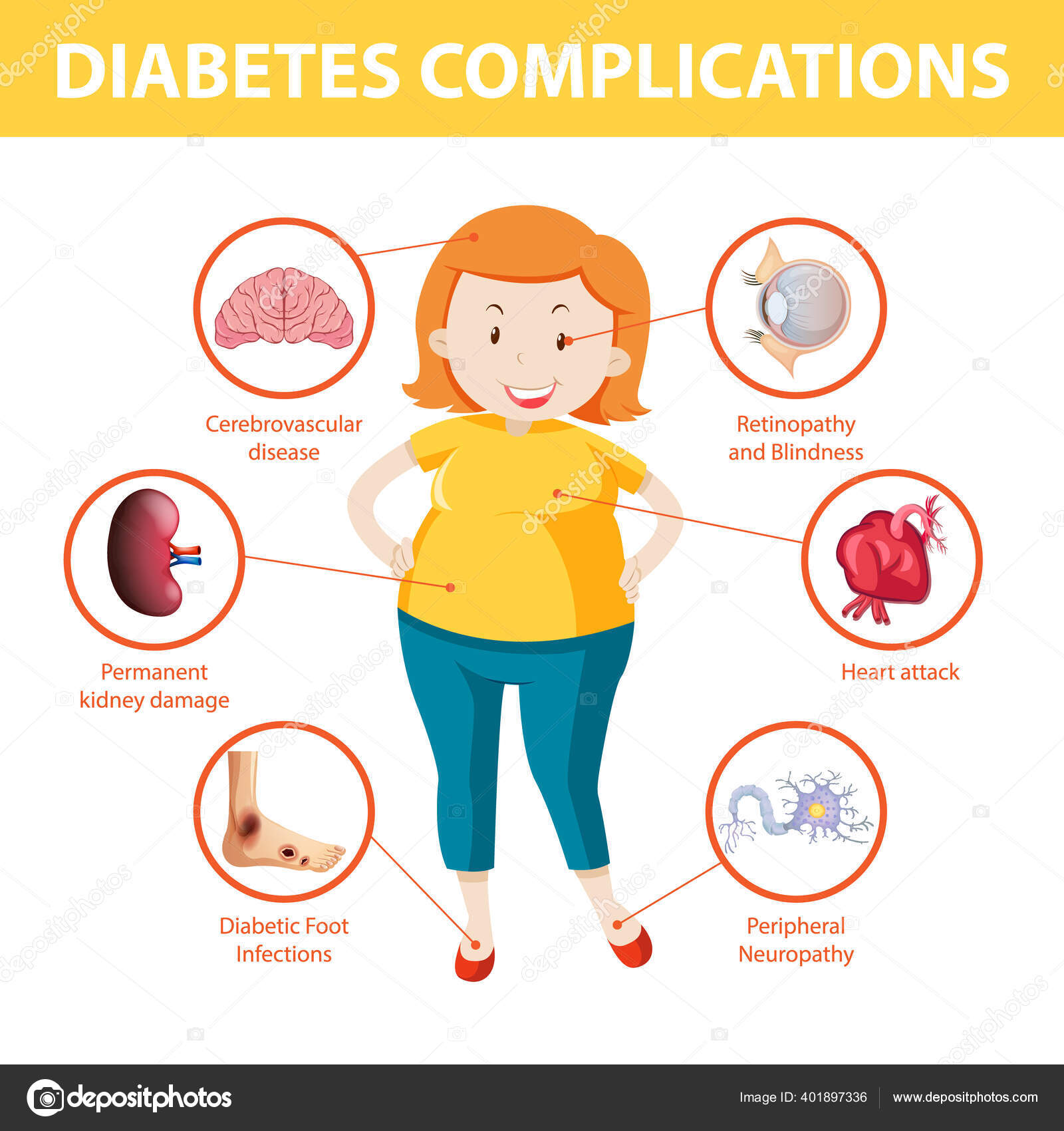 Diabetes Complications Information Infographic Illustration Stock ... Diabetes Complications Information Infographic Illustration Stock ...