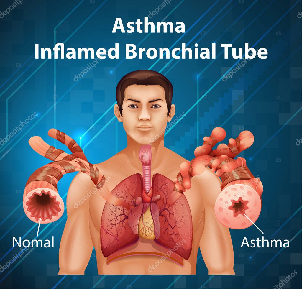 Anatomía Humana Asma Inflamed Bronchial Tube Diagrama Ilustración ...