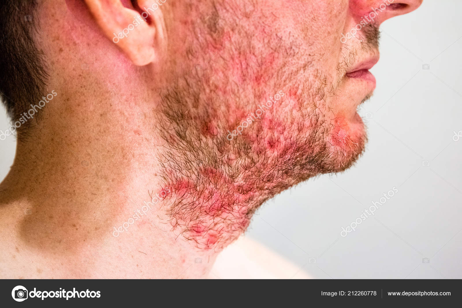 Eczema Face