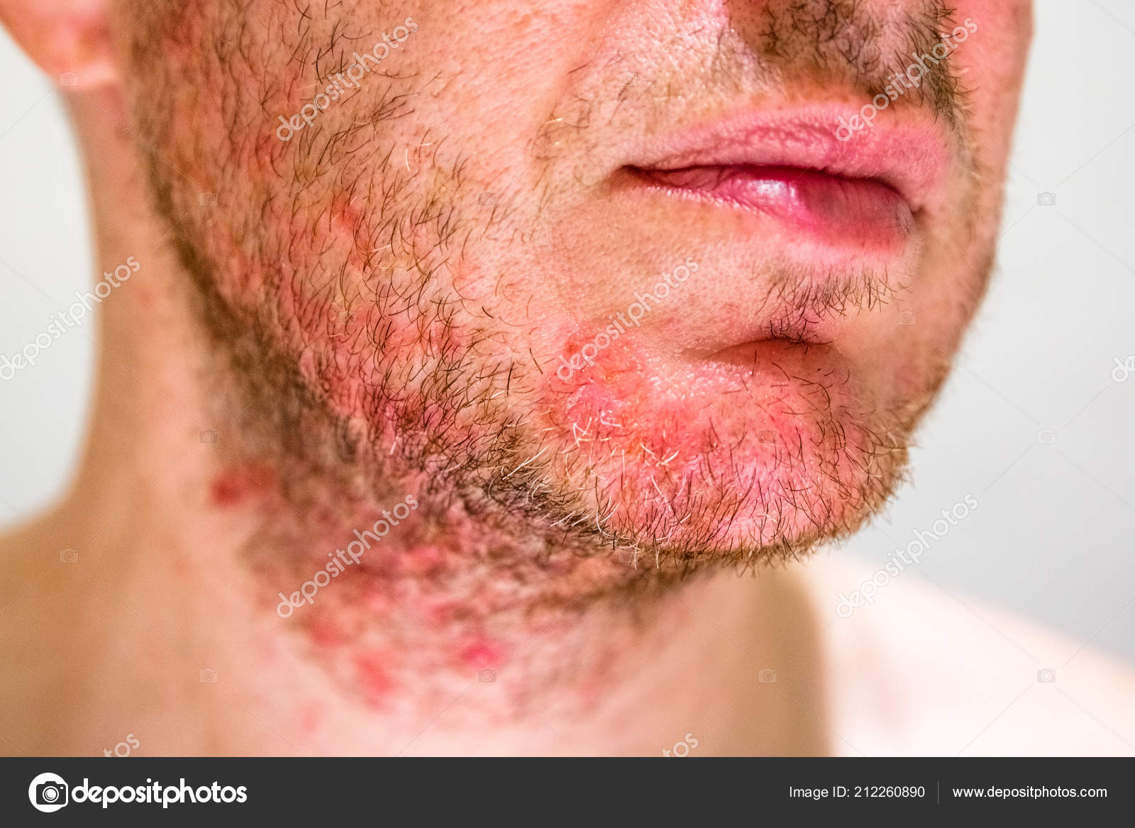 Man with seborrheic dermatitis in the beard area Stock Photo by ©doble ...