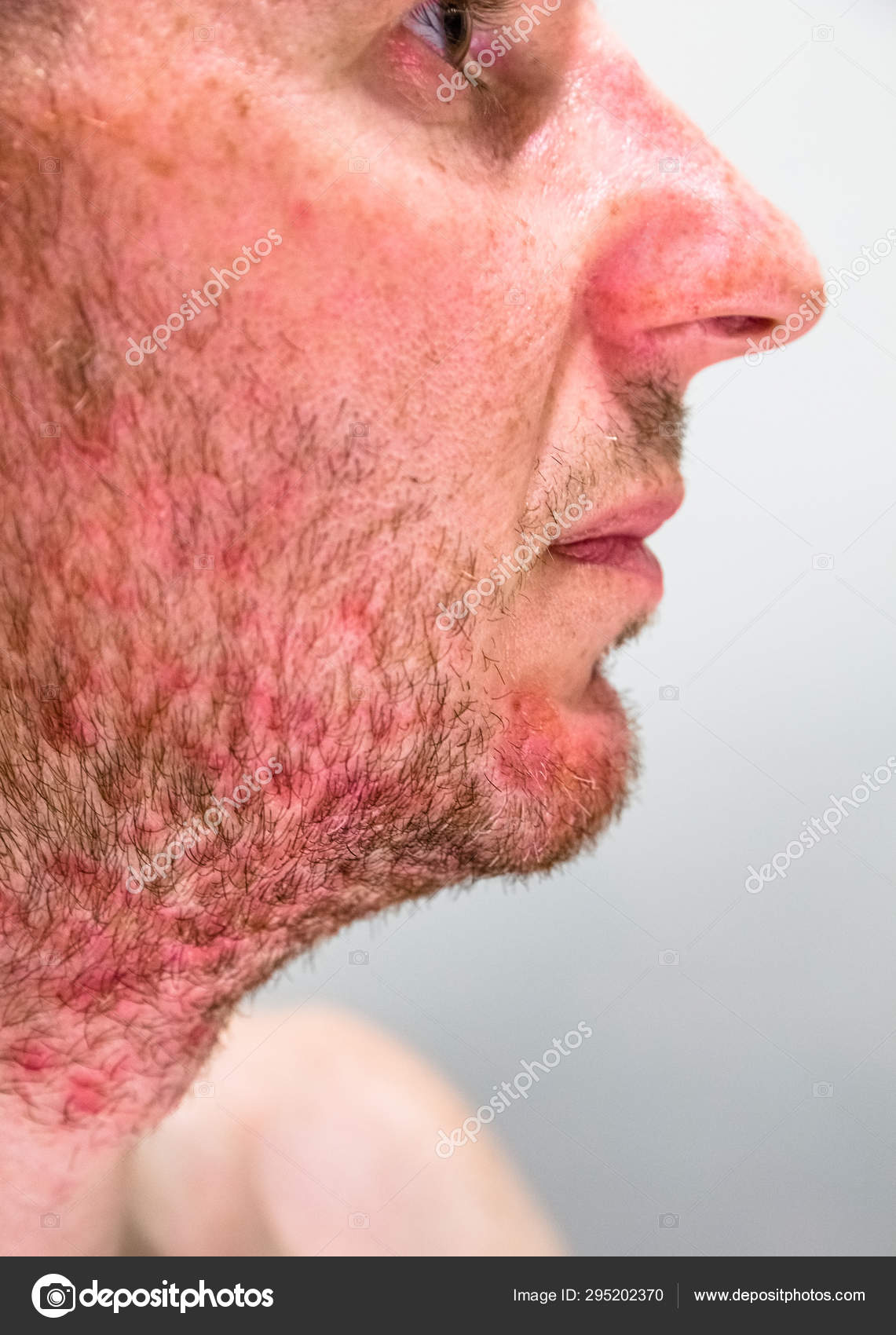Man with seborrheic dermatitis in the beard area Stock Photo by ©doble ...