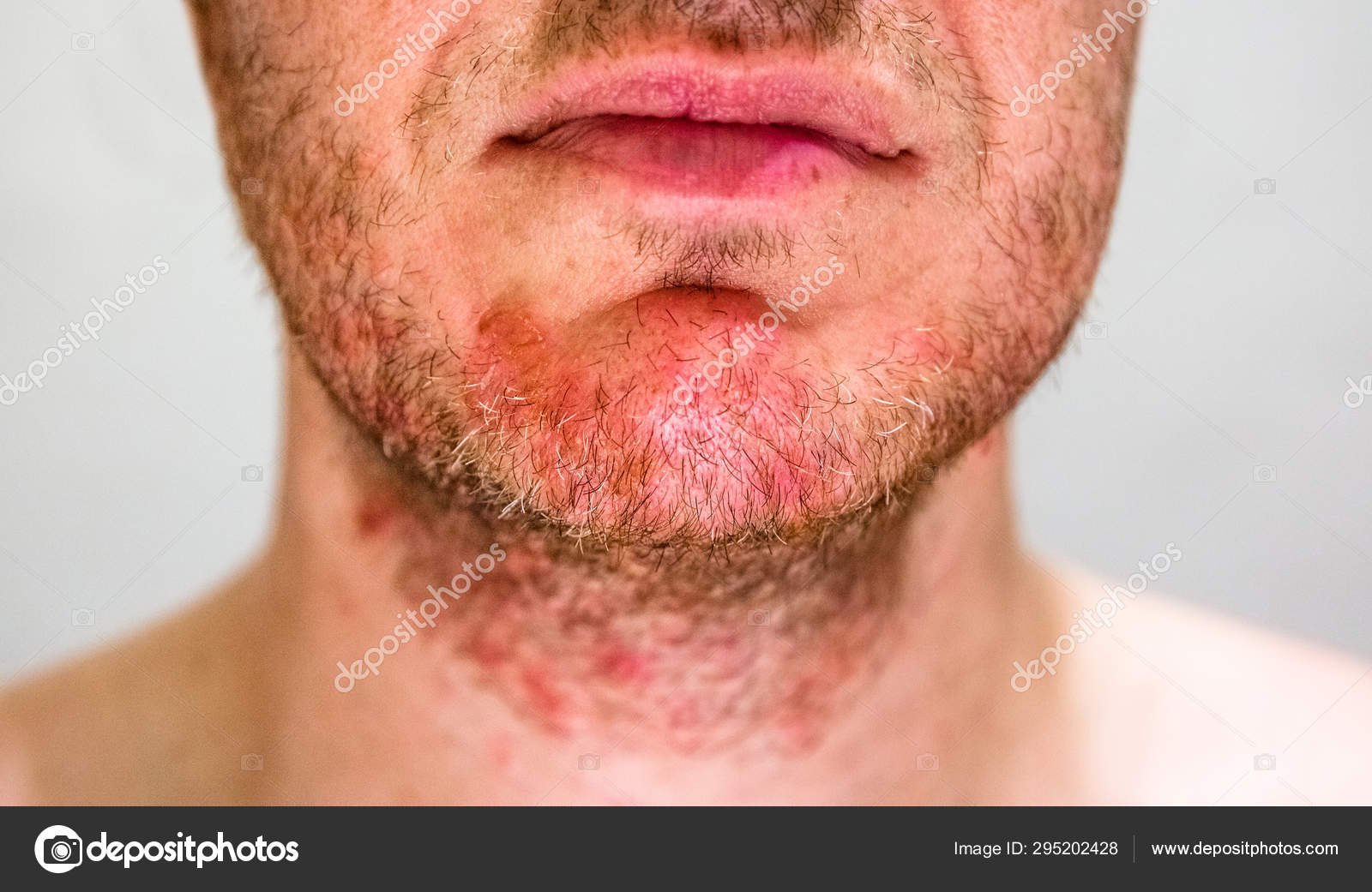 Man with seborrheic dermatitis in the beard area Stock Photo by ©doble ...