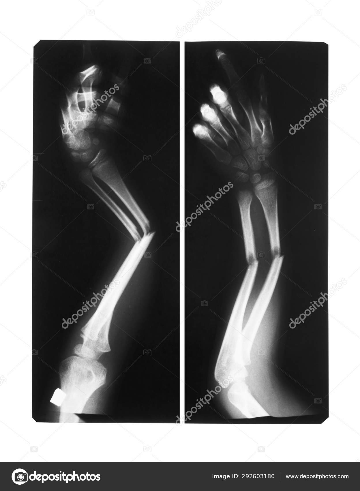 Show double fracture arm bones — Stock Photo © pioneer111 #292603180