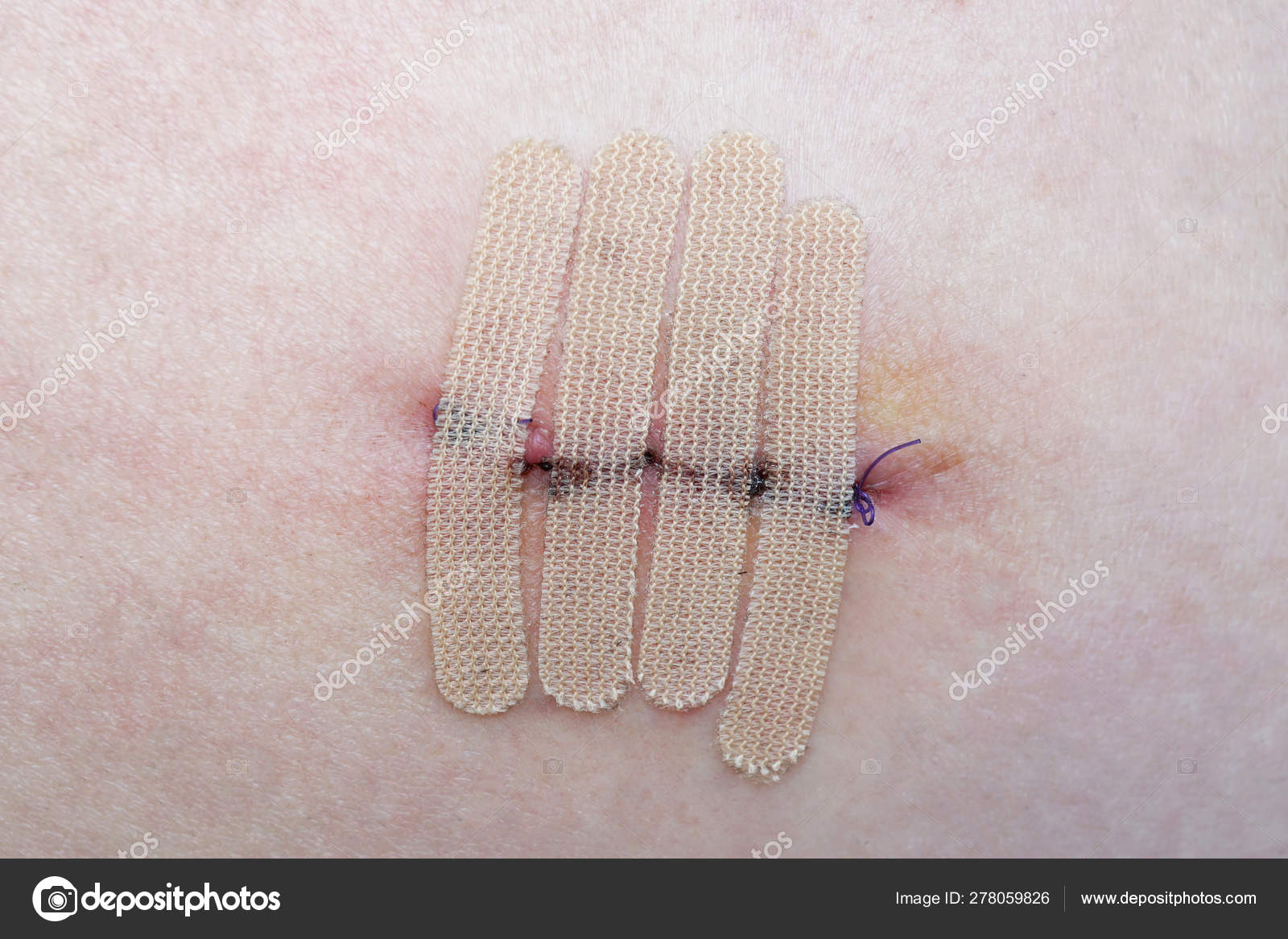 Skin with suture and wound closure strips or surgical tape — Stock ...
