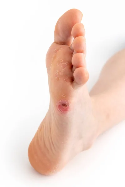 Verrue plantaire Stock Photos, Royalty Free Verrue plantaire Images ...