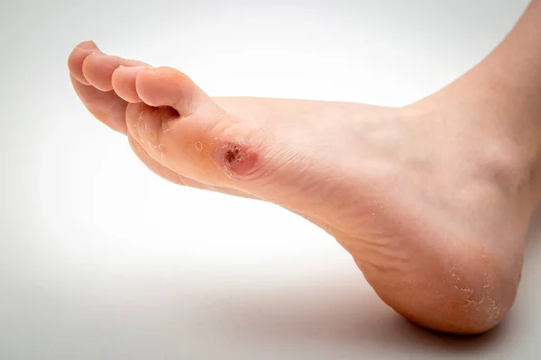 Verrue plantaire images libres de droit, photos de Verrue plantaire ...