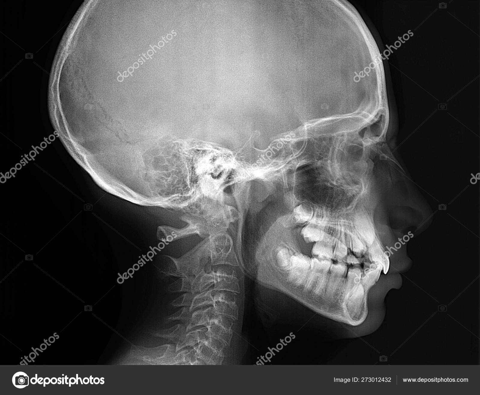 Film Ray Skull Cervical Spine Lateral View Years Boy — Stock Photo ...